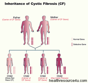 Cystic Fibrosis : Causes, Symptoms, Testing And Treatment