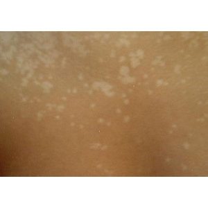 Skin Discoloration : Causes, Types, Picture And Treatment
