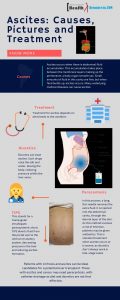 Ascites: Causes, Pictures, Symptoms And Treatment