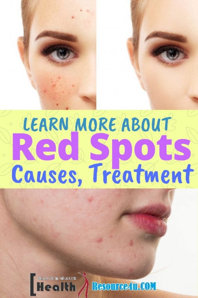 Red Spots On The Skin - Symptoms, Causes And Home Treatment